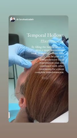 Transform Your Look with Temporal Hollow Filler | Comprehensive Facial ...