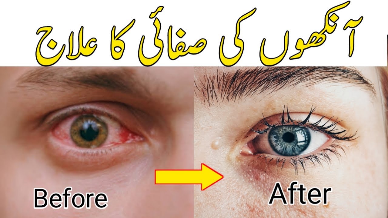 How to Get Clear and Brighten Eyes | Eyes Whitening Tips | The Pharmfit ...