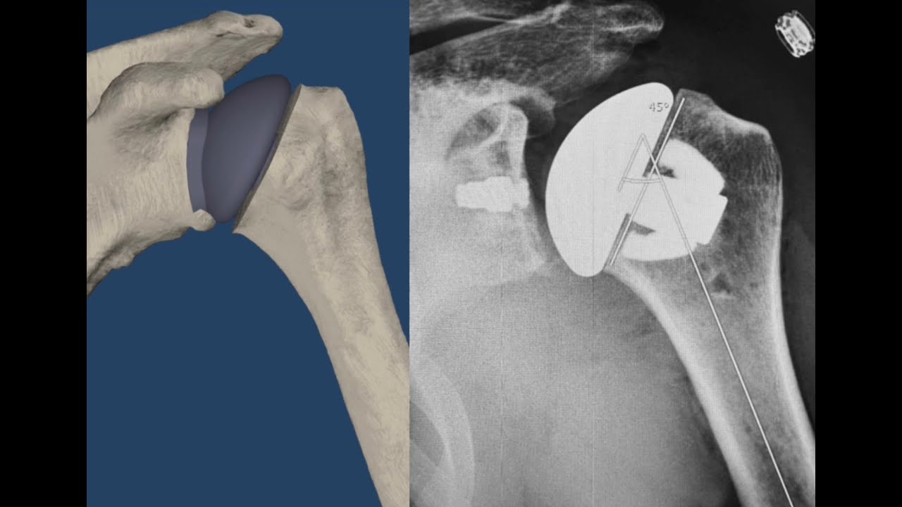 Total Shoulder computer planning David Schneider MD - YouTube