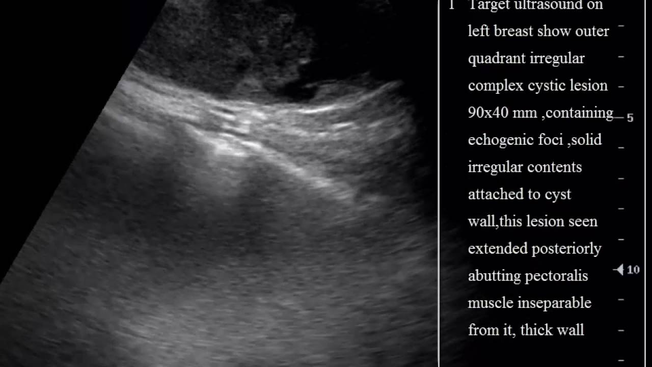 CASE 197 SONOMAMMOGRAPHY LEFT BREAST IDC - YouTube