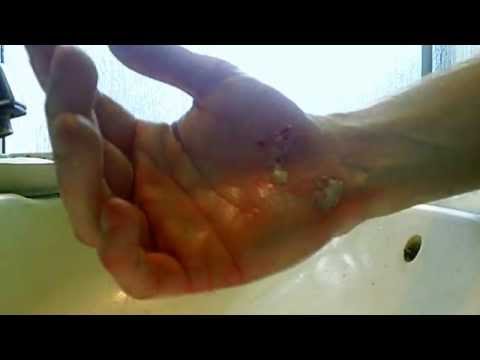 Hydrogen Peroxide On Cut