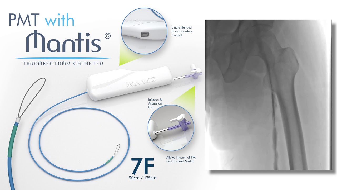 Mantis®️ Thrombectomy System for DVT - YouTube