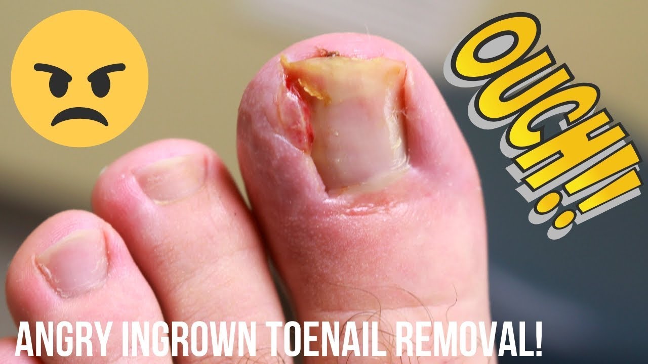 Angry Ingrown Toenail Removal! - YouTube