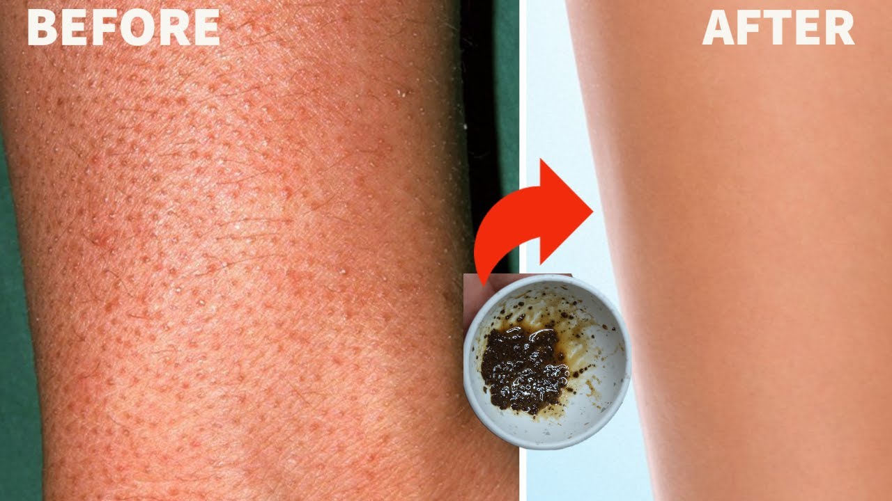 BEST REALISTIC STRAWBERRY LEGS HOME REMEDY - YouTube