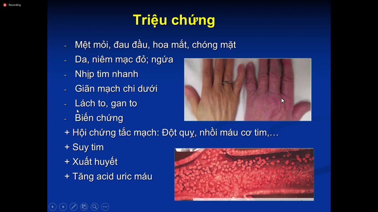YHHN- YHHN điều trị(tuyến giáp, đa hồng cầu) - YouTube
