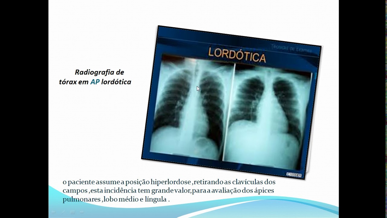 incidências radiografica do toráx AP LORDÓTICA - YouTube