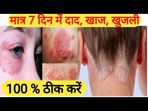 Derobin Ointment | Fungal infection treatment | fungal infection in ...