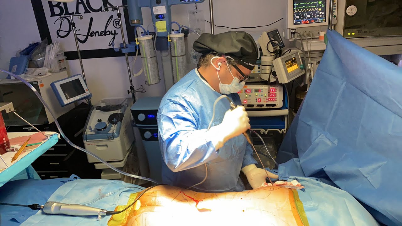 Lipo 360 Skinny bbl surgery | Dr Jeneby Skinny bbl surgery - YouTube