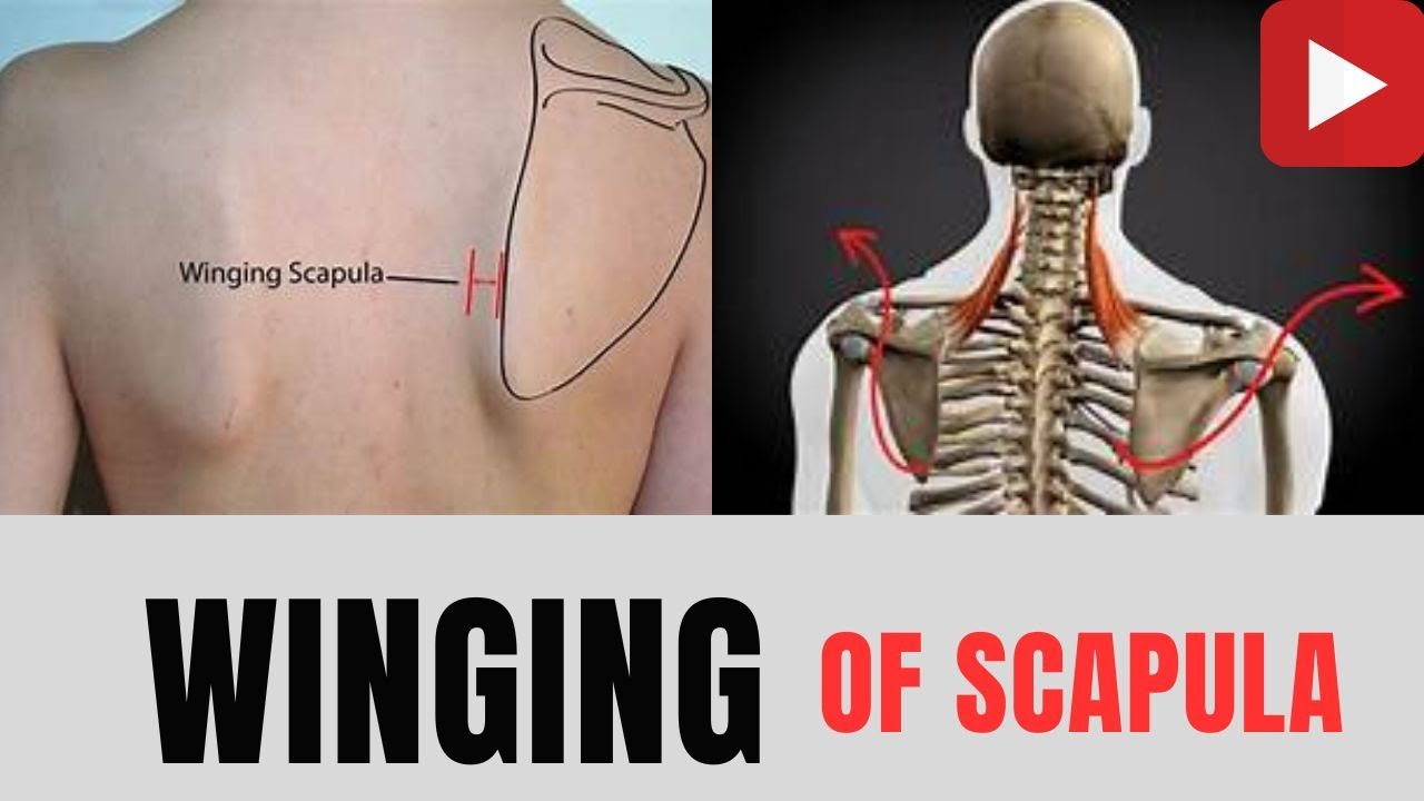 WINGING Of SCAPULA|Causes|Treatment|#winging #scapula #causes #treatment #anatomy #demage #nerve ...