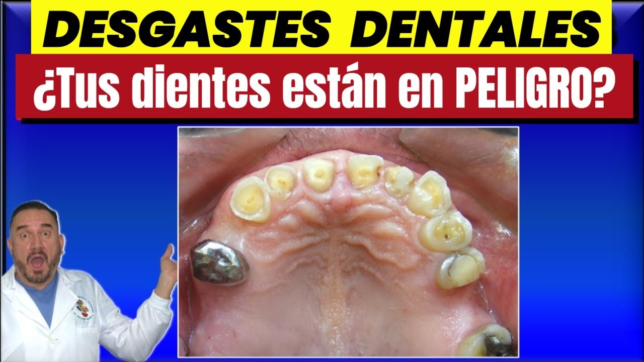 DESGASTE DENTAL: Atrición Abrasión Corrosión & Abfracción Explicados ...