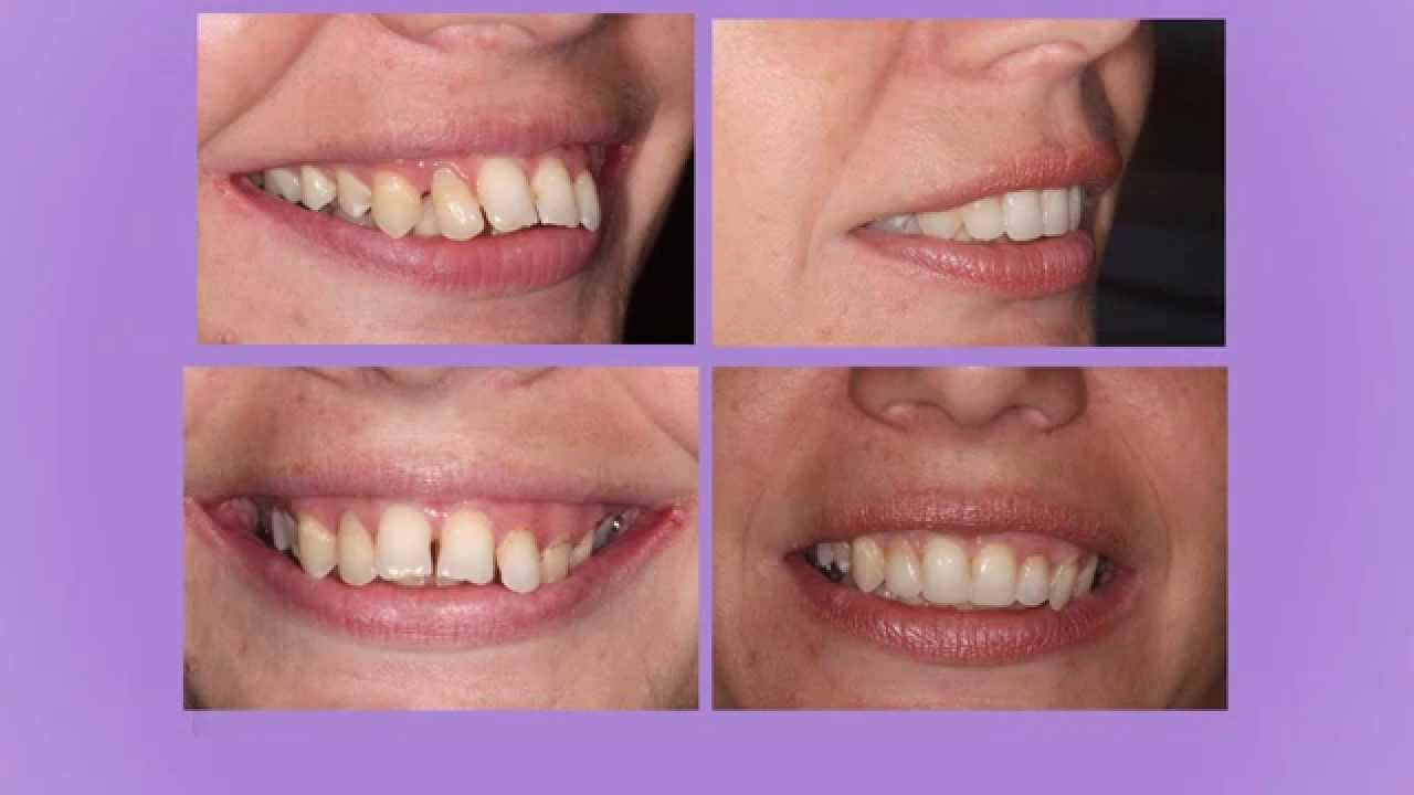 Ever wished for straight teeth? See our amazing results with Invisalign ...
