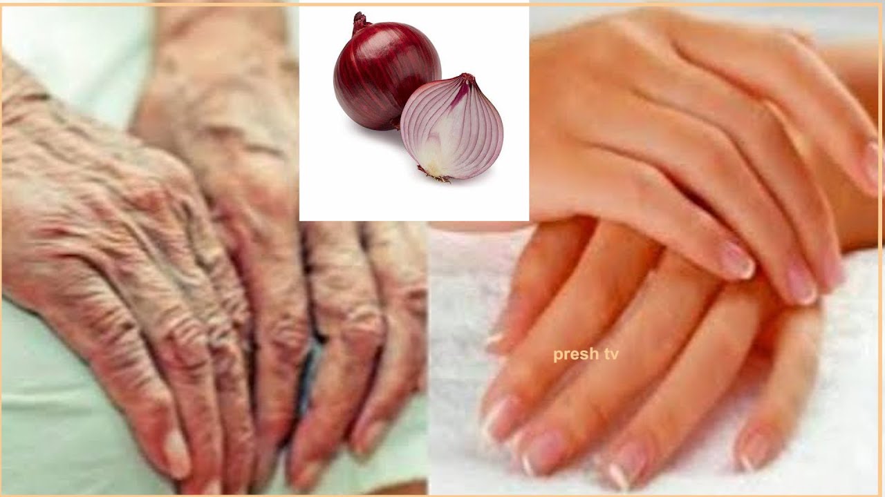 Use lemon onion wash for 5 days to remove wrinkles from hands ...