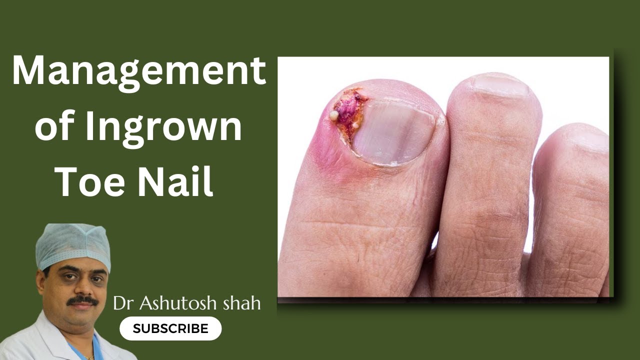 Management of Ingrown Toe Nail | Best Care to Avoid Ingrown Toe Nail ...
