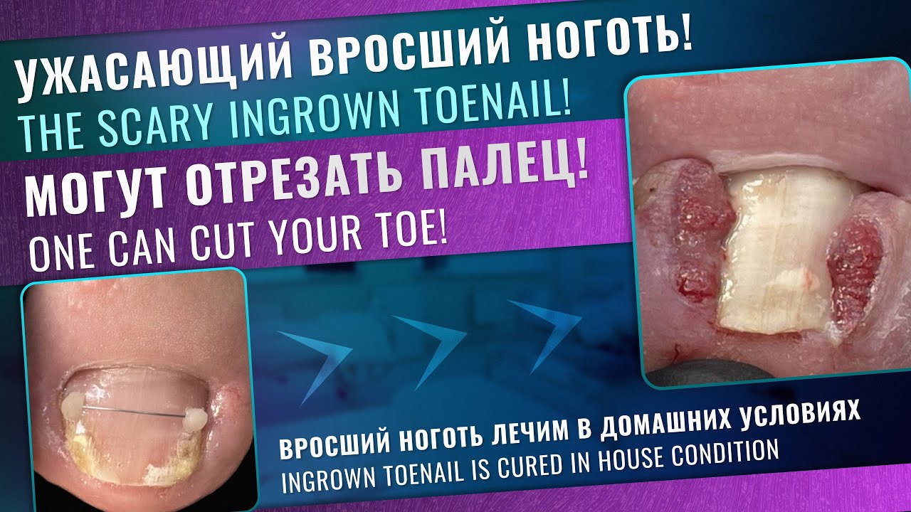 Ужасающий вросший ноготь / The scary ingrown toenail! /Динамика # ...