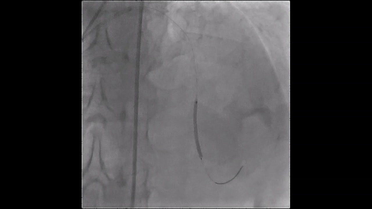 BICTO: Bifurcation and CTO/ LMCA-TAP stenting and LAD- CTO - YouTube
