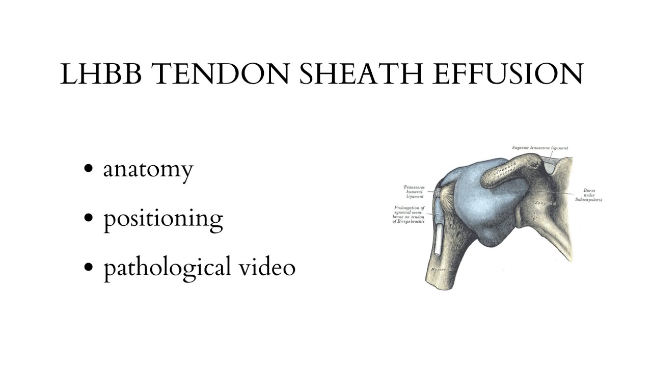LONG HEAD BICEPS BRACHII TENDON SHEAT EFFUSION - musculoskeletal ...