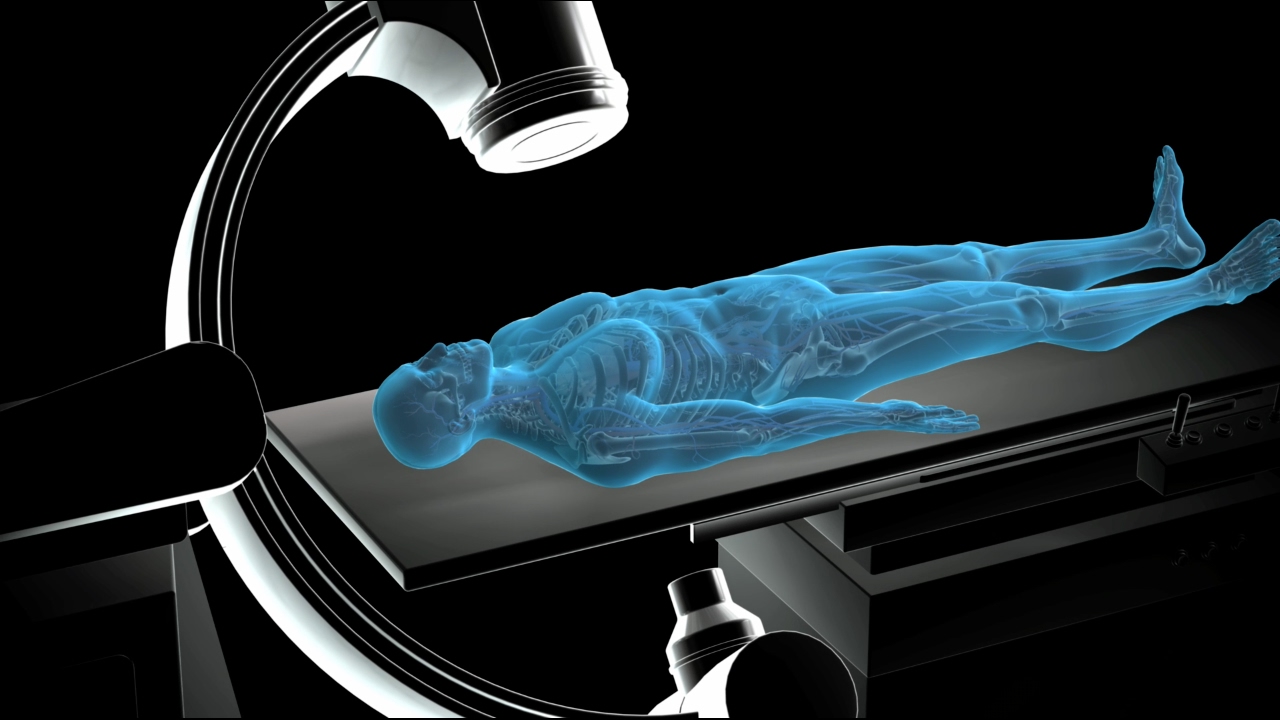 Non Cardiac Percutaneous Transluminal Angioplasty | NCPTA | Nucleus ...