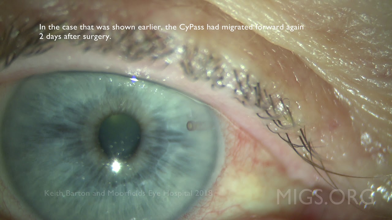 Cypass Implantation - Technique and Positioning - YouTube