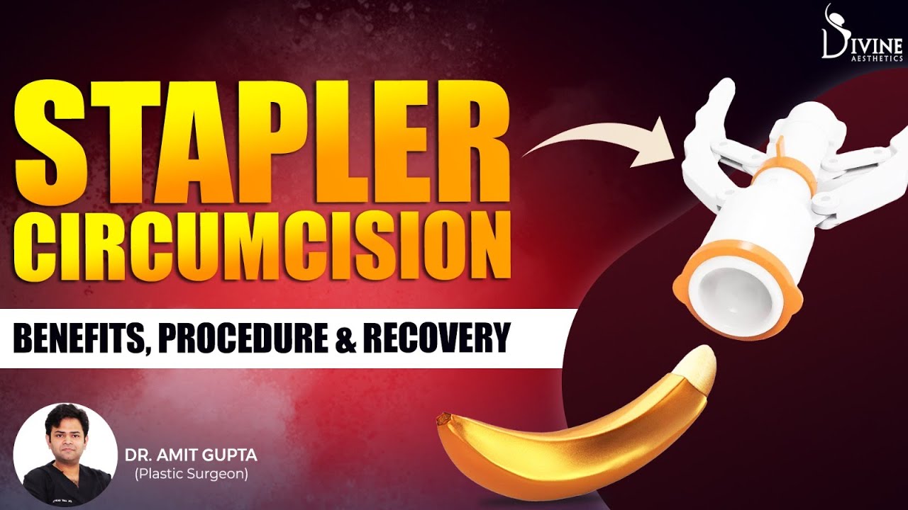 Stapler Circumcision - Benefits, Procedure & Recovery | Foreskin ...