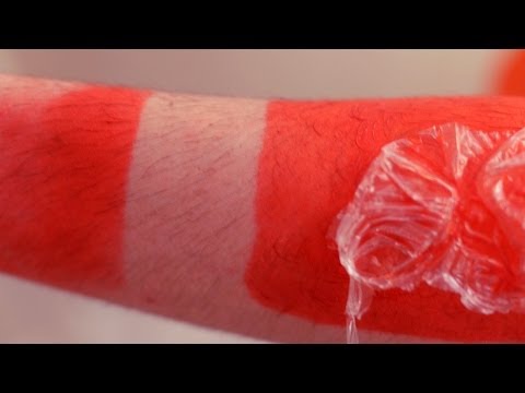 WORLD'S WORST SUNBURN!