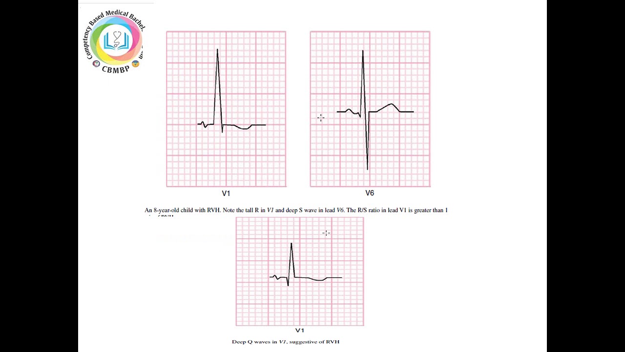 ECG in CHD - YouTube