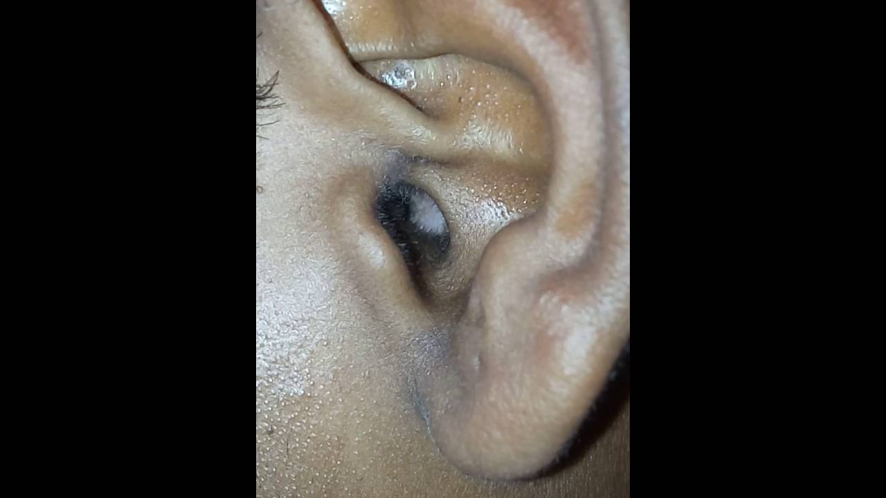 Insect in ear(1) - YouTube