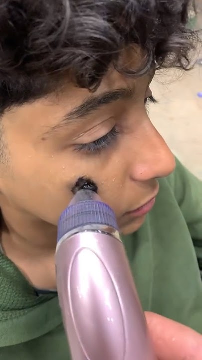 ازاله الحبايه المسلطنه من الوجهه😰🥵 ️ Fyp Foryou Viral Trending Shorts Foryoupage Youtube