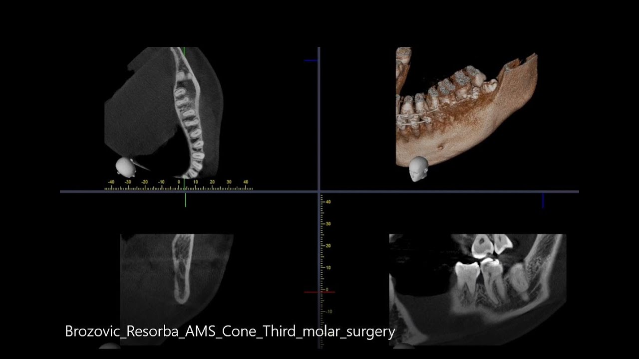 Parasorb Cone - YouTube