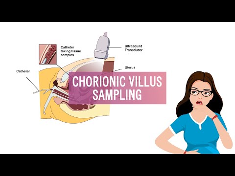What is Chorionic Villus Sampling? || CHORIONIC VILLUS SAMPLING ...