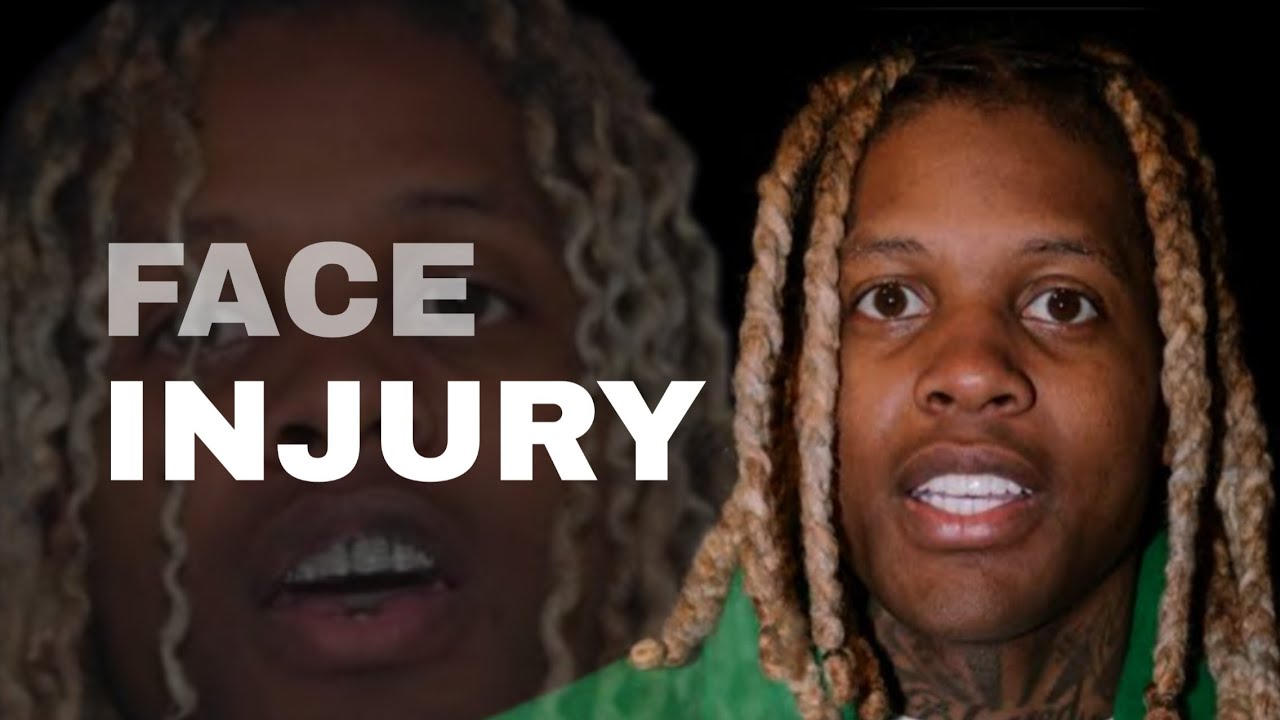 Lil Durk Face Injury ( Coursed By Explosion) - YouTube