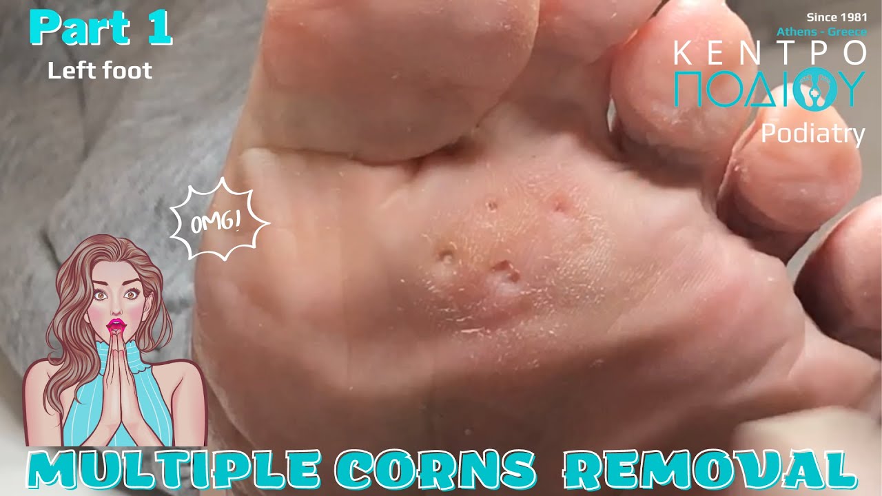 Multiple corns removal|Αφαίρεση πολλαπλών τύλων|Κέντρο Ποδιού Podiatry ...