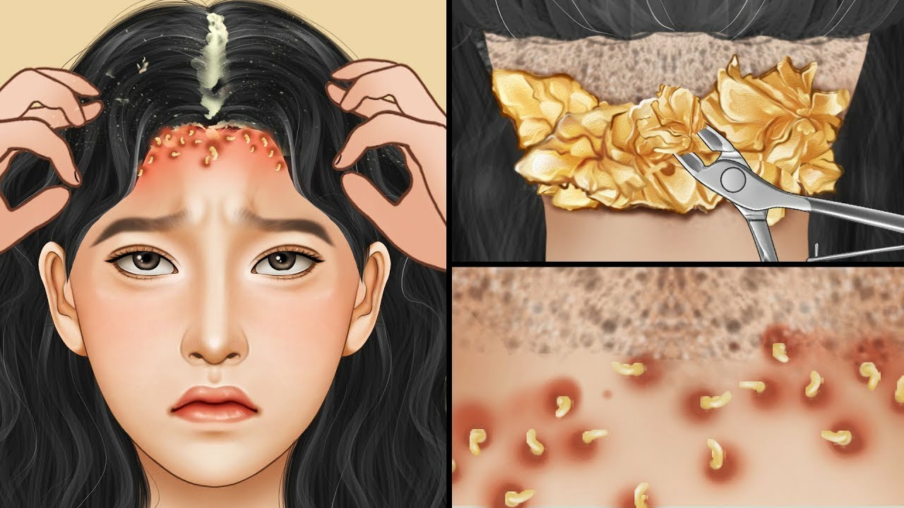 ASMR Giant hardened flakes dandruff removal at hairline - Scalp ...