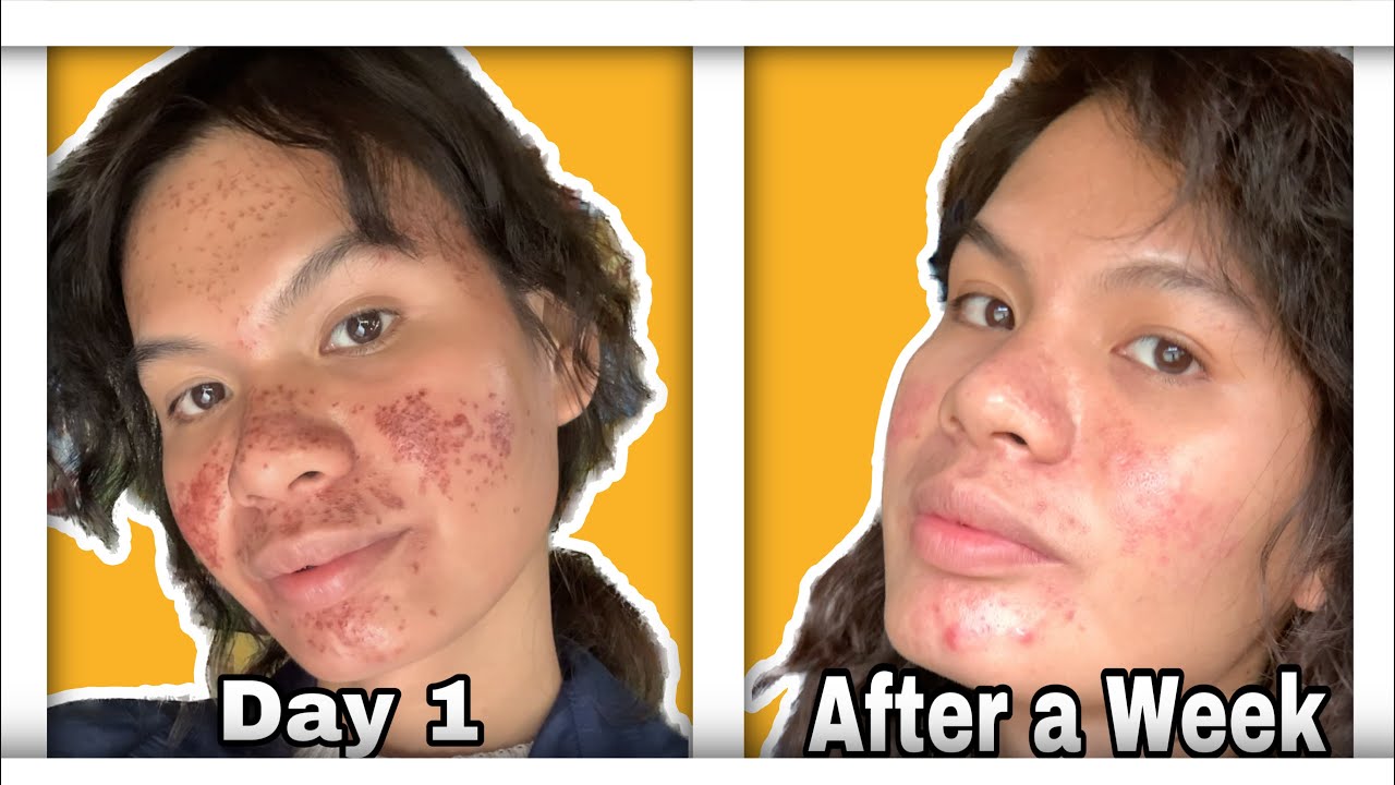 TCA CROSS Day by Day | Healing Stages | TCA CROSS PHILIPPINES #diy # ...