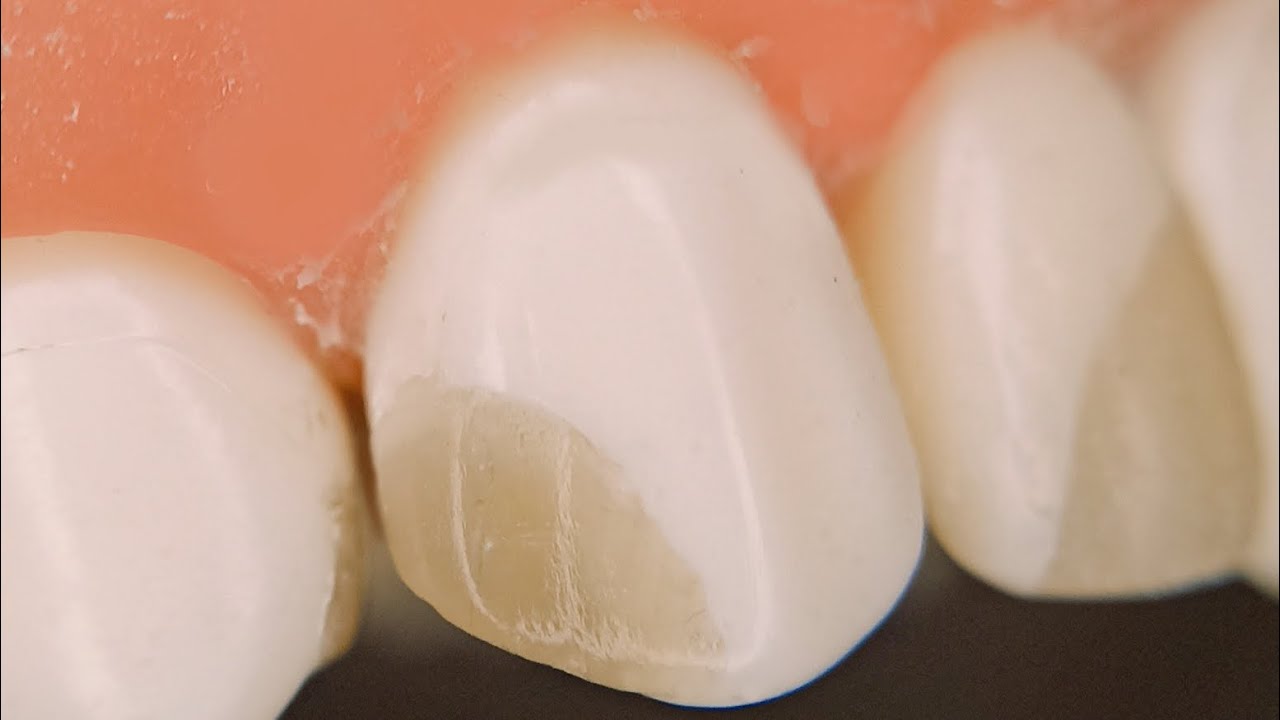 Class IV upper 3 & Class II upper 4 composite filling restoration ...