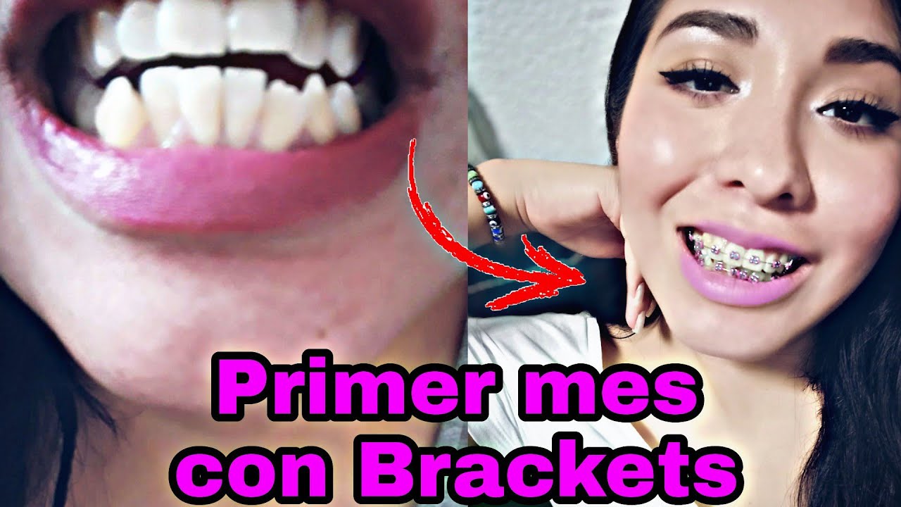 Primer mes con brackets | cambios y sensaciones 🦷😁 - YouTube
