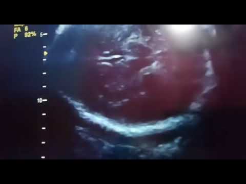 USG Baby “R” 37Weeks - YouTube