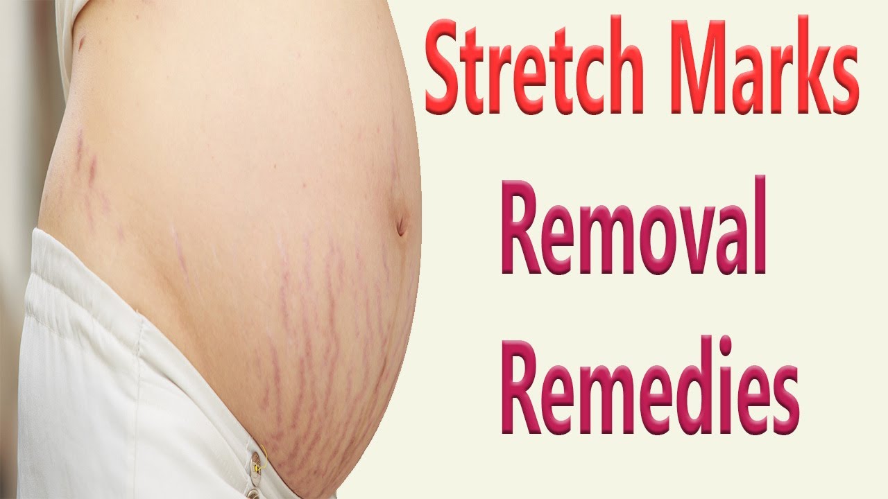 8 Fast Removal Remedies For Stretch Marks | How To Get Rid Of Stretch ...