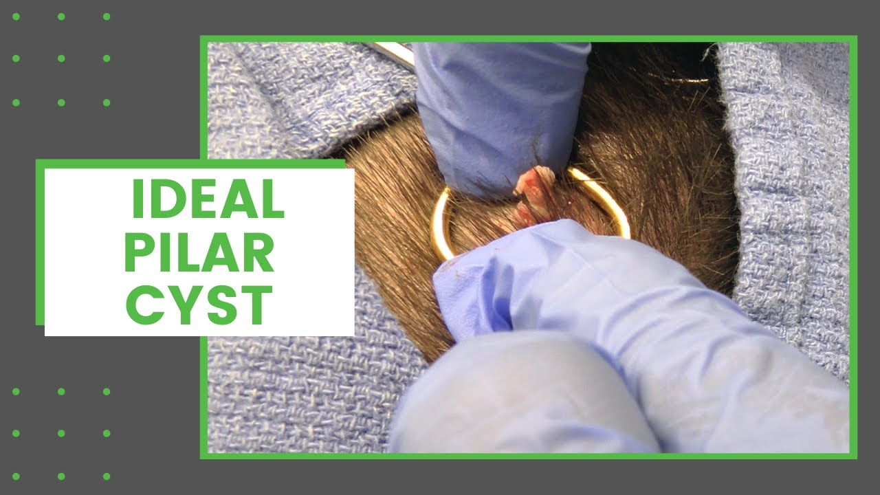 Ideal Pilar Cyst | Dr. Derm - YouTube