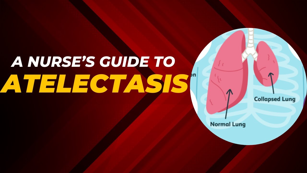 Atelectasis: Definition, Etiology, Pathophysiology, Classification ...
