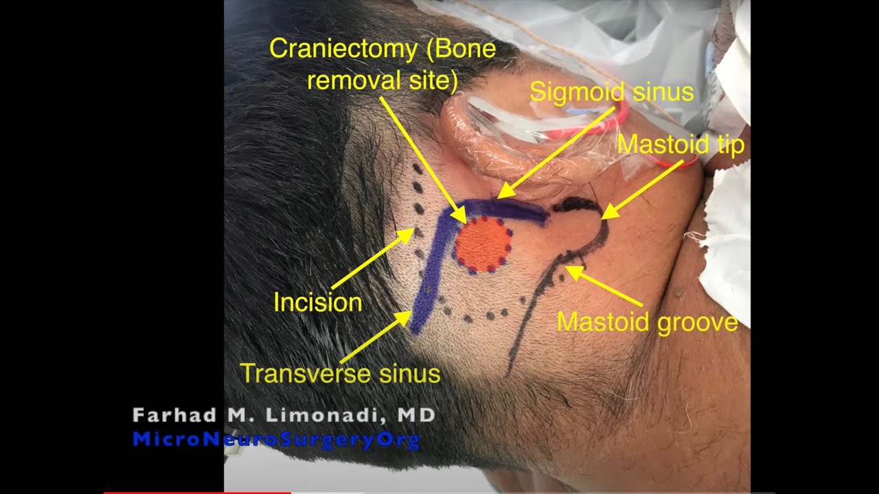 Microvascular Decompression (MVD) of facial nerve. Surgical treatment ...