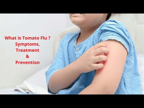Tomato Flu- Symptoms, Causes & Treatment.