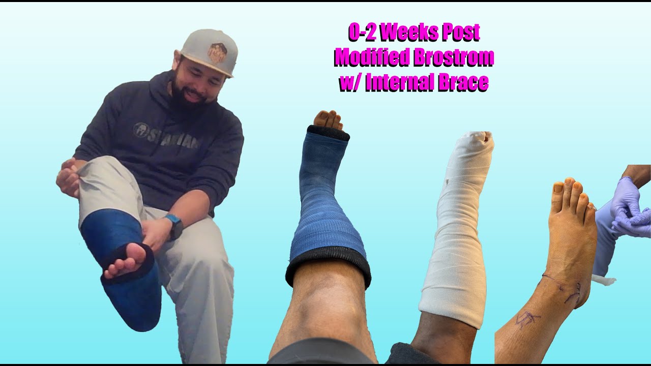 0-2 Weeks Post Modified Brostrom w/ Internal Brace - YouTube