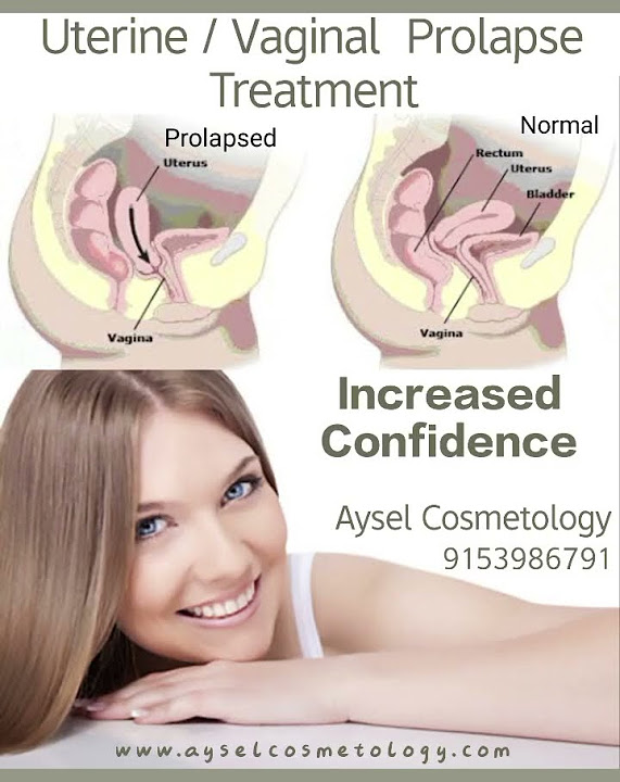 Vaginal Prolapse Treatment. - YouTube