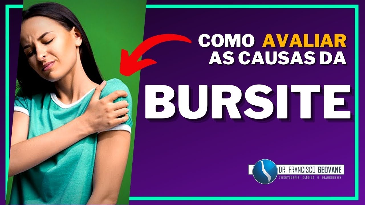 BURSITE SUBACROMIAL SUBDELTÓIDEA - Como AVALIAR a CAUSA da BURSITE DO ...