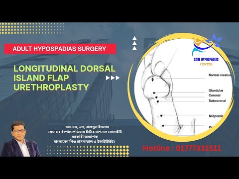 Longitudinal Dorsal Island Flap Urethroplasty|Adult Hypospadias Surgery ...