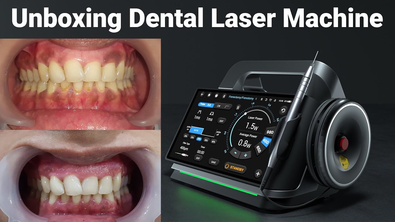 Unboxing PIOON Dental Laser Machine | Dental Aesthetics | Benefits Of ...
