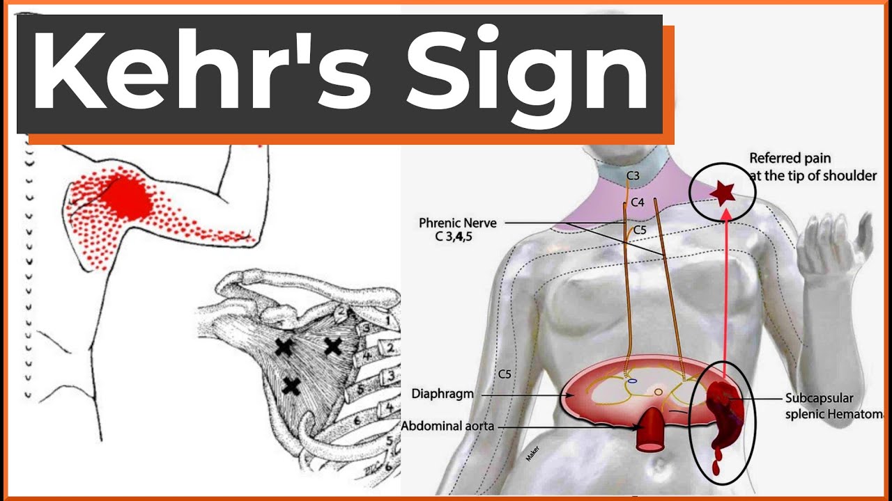 Kehr's Sign | Splenic Rupture - YouTube