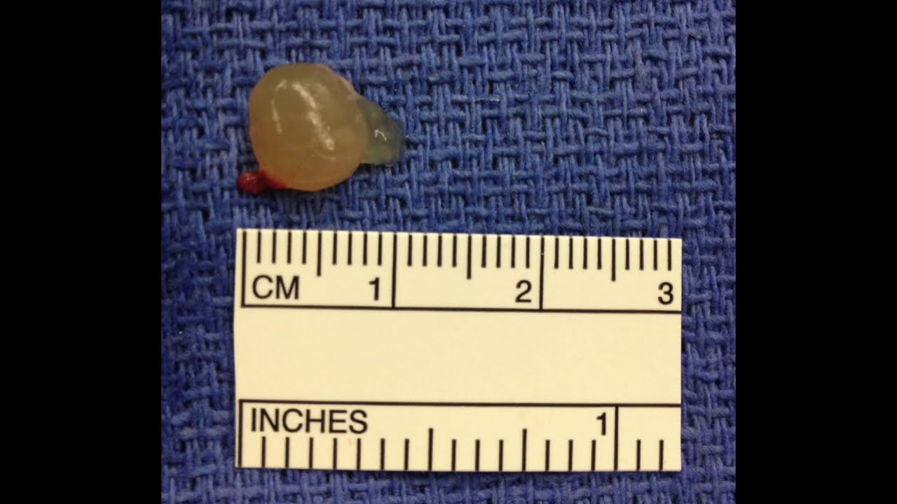 Endoscopic colloid cyst resection - YouTube