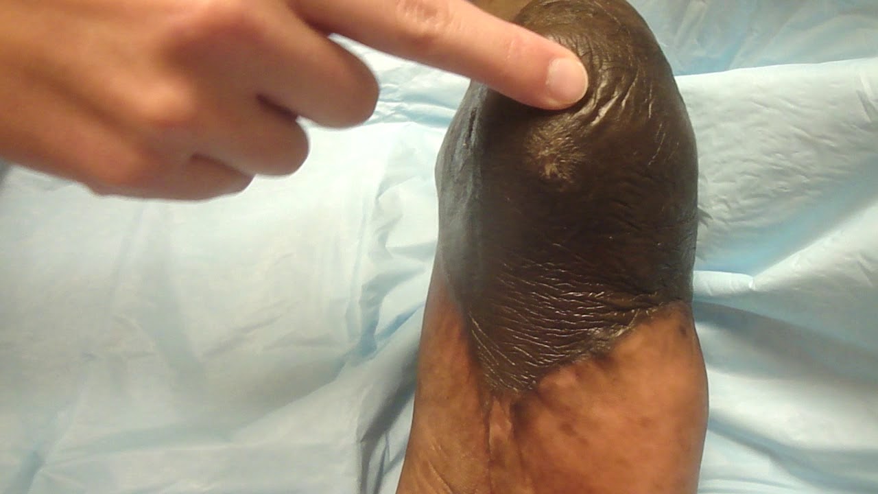 Right Posterior Heel Degloving Wound MatriStem YouTube right-posterior-heel-degloving-wound-matristem-youtube