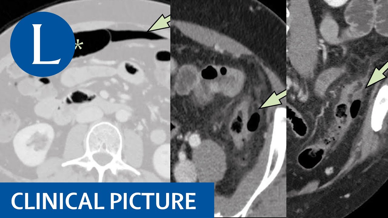 Conservative management of perforated diverticulitis. - YouTube